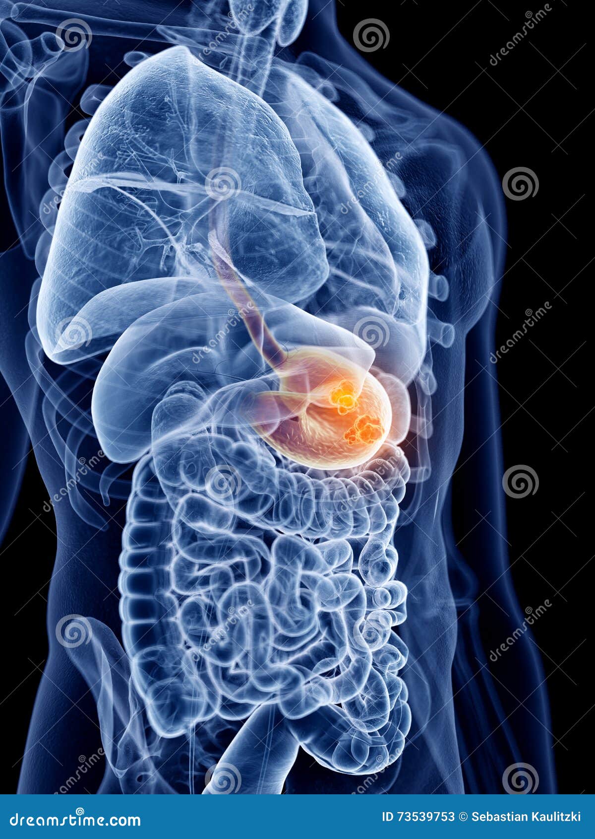 Stomach cancer stock illustration. Illustration of biology - 73539753