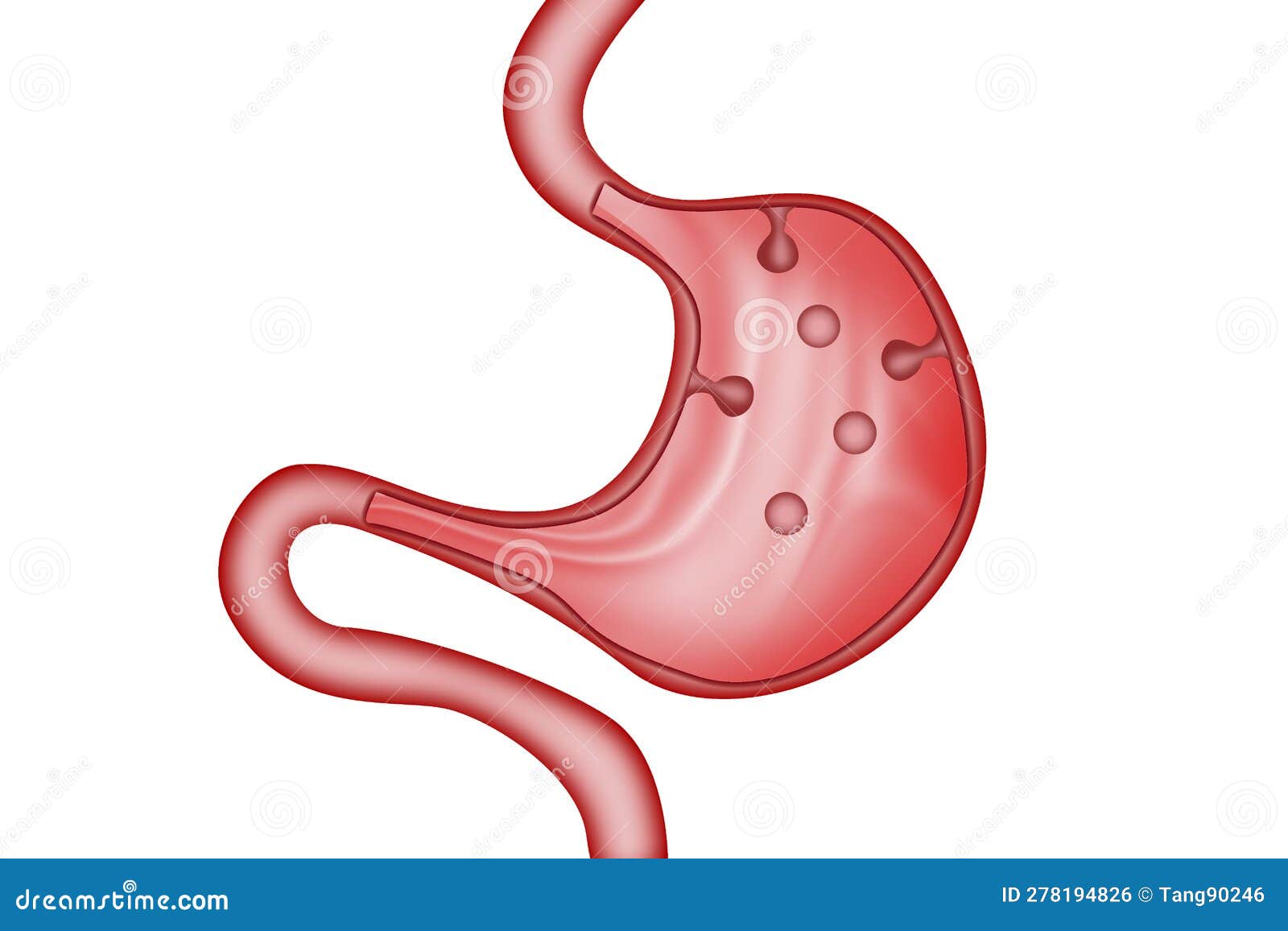 Polyps In Stomach. Gastric Polyp. Medical Illustration Cartoon Vector ...