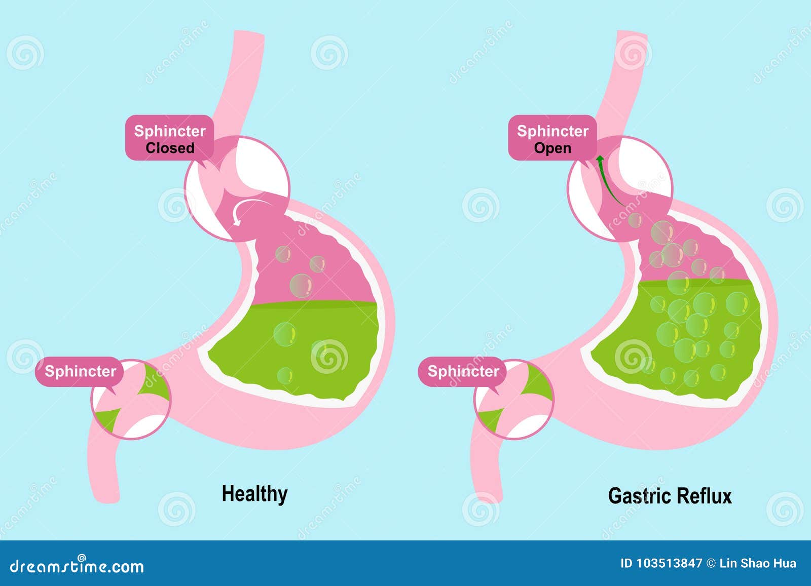 Sphincter Cartoons, Illustrations & Vector Stock Images - 1700 Pictures ...