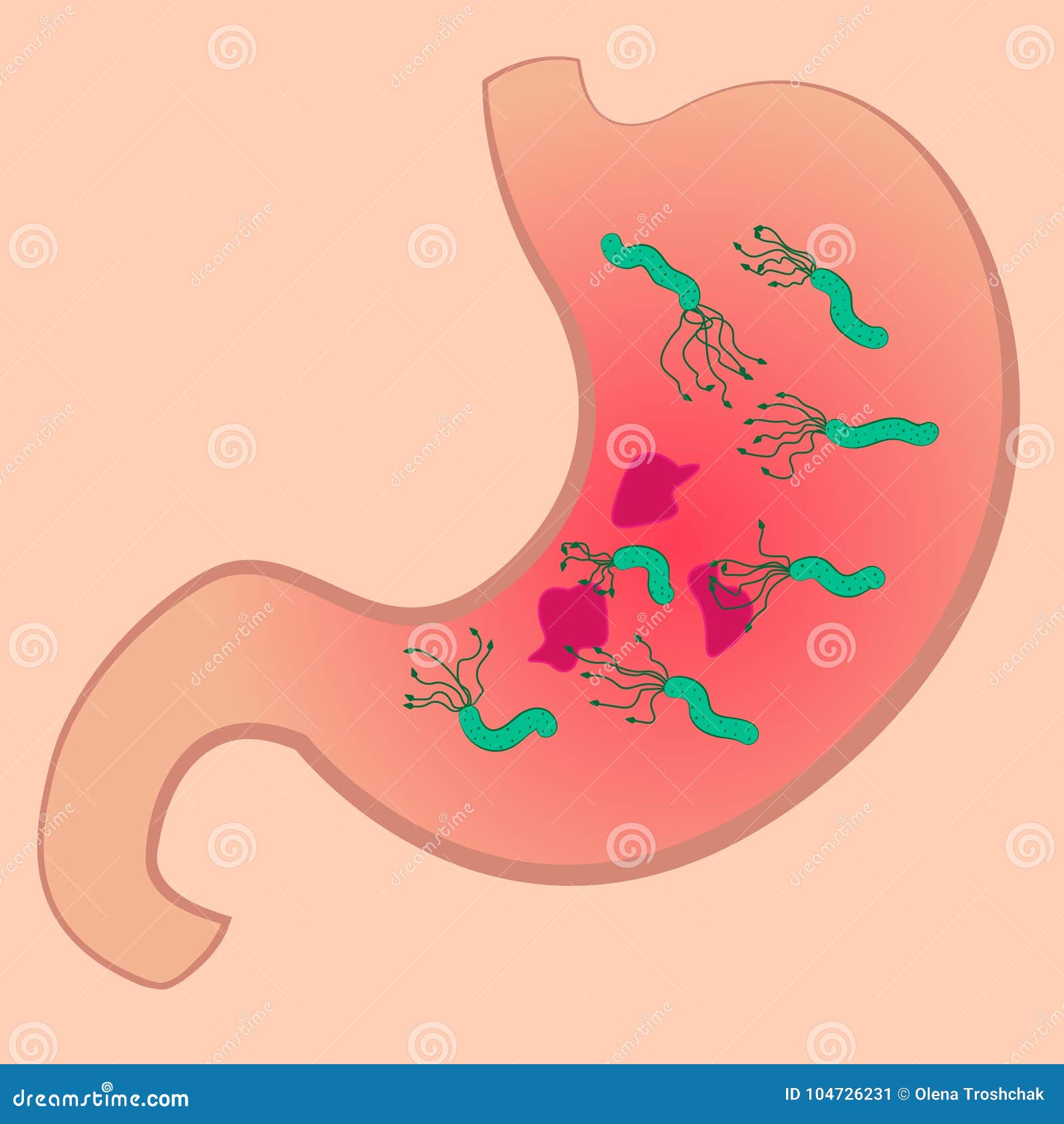 A Stomach with Ucler and Helicobacter Pylori Stock Vector ...