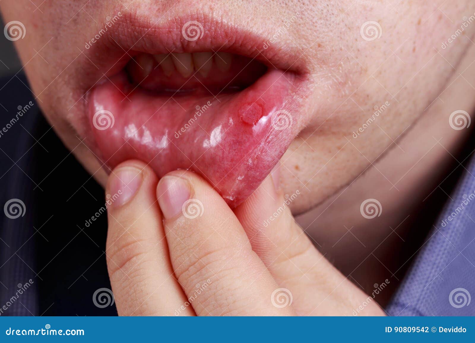 Stomatitis On The Lips Stock Image | CartoonDealer.com #91599397