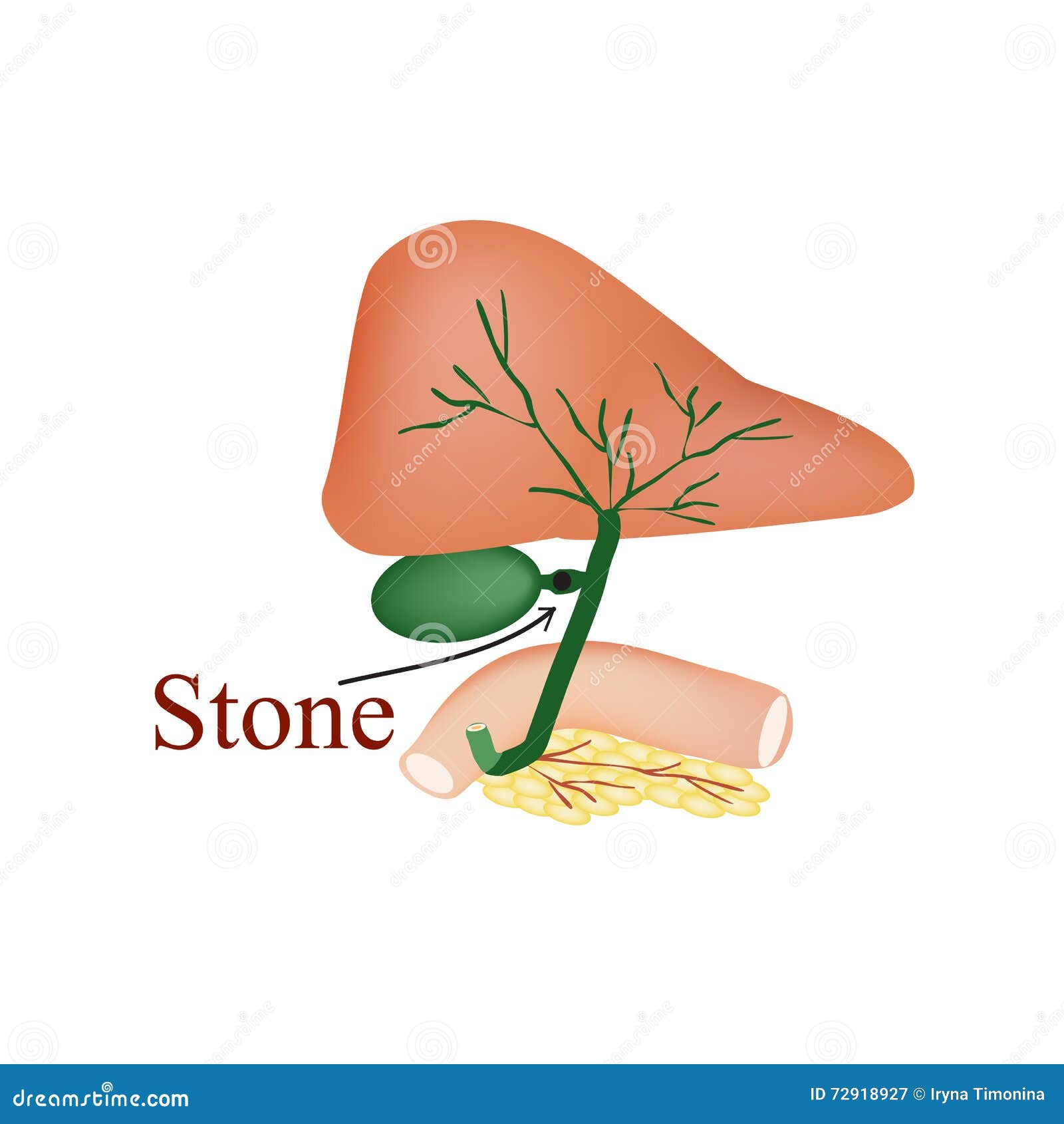 Stone Bile Duct. Gallbladder, Duodenum, Pancreas, Bile Ducts. Vector ...