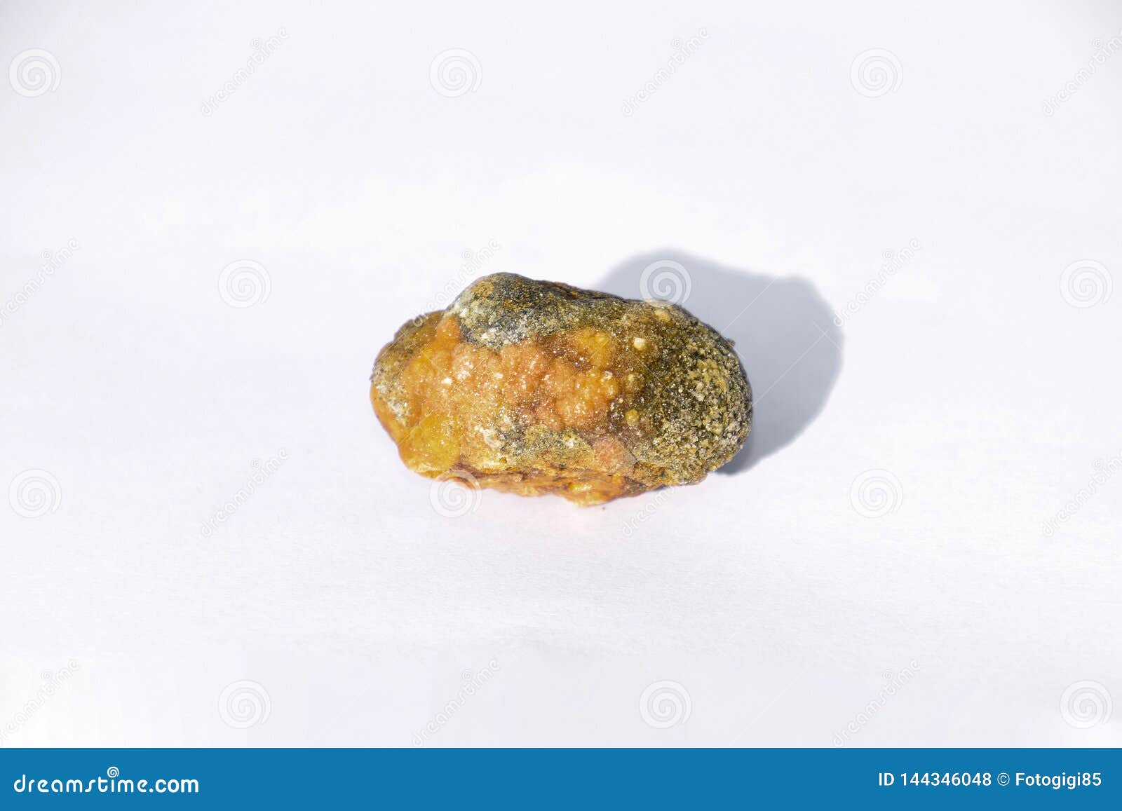 Stone of Gallbladder. the Result of Gallstones. a Calculus of ...