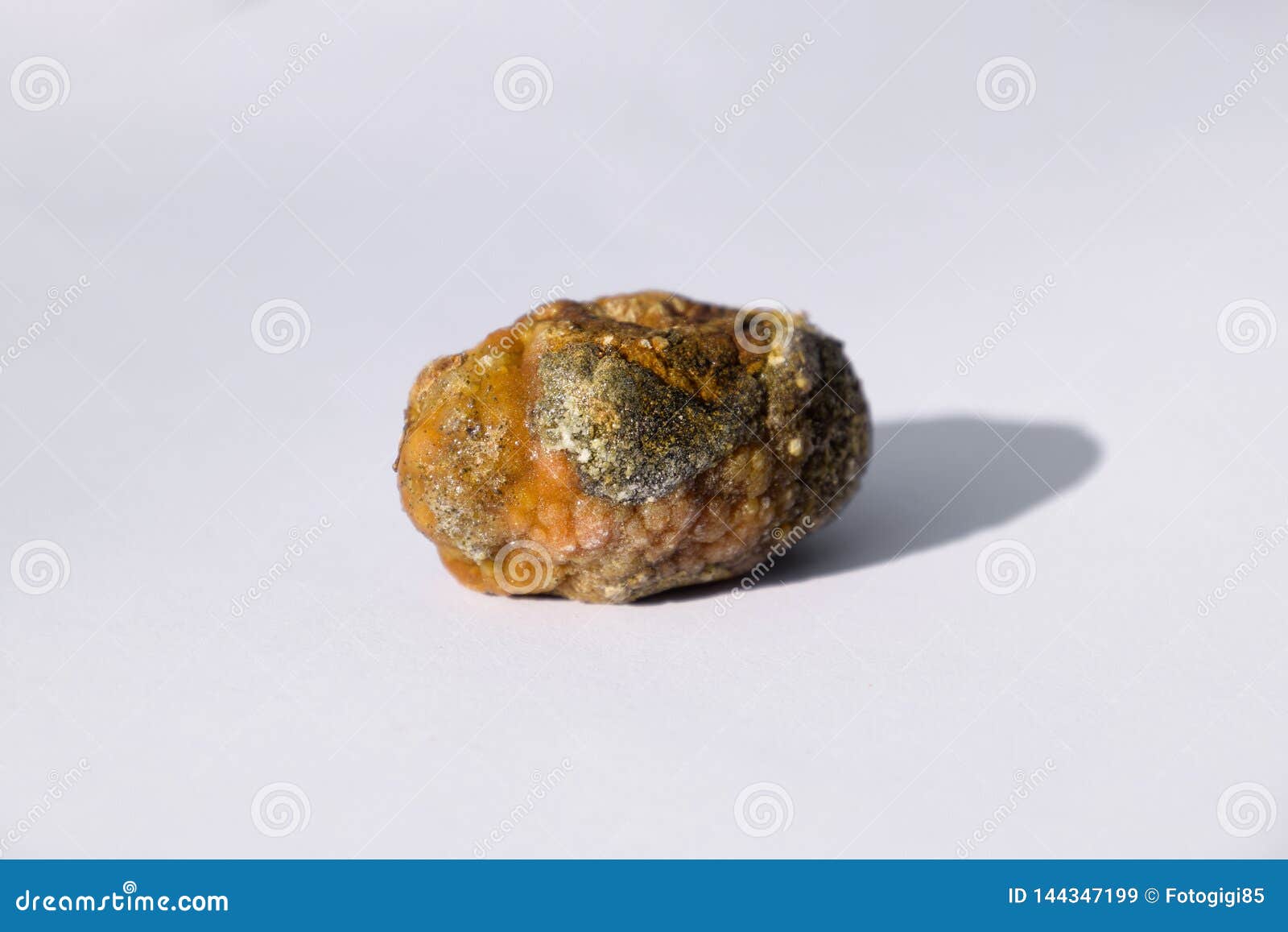Stone of Gallbladder. the Result of Gallstones. a Calculus of ...