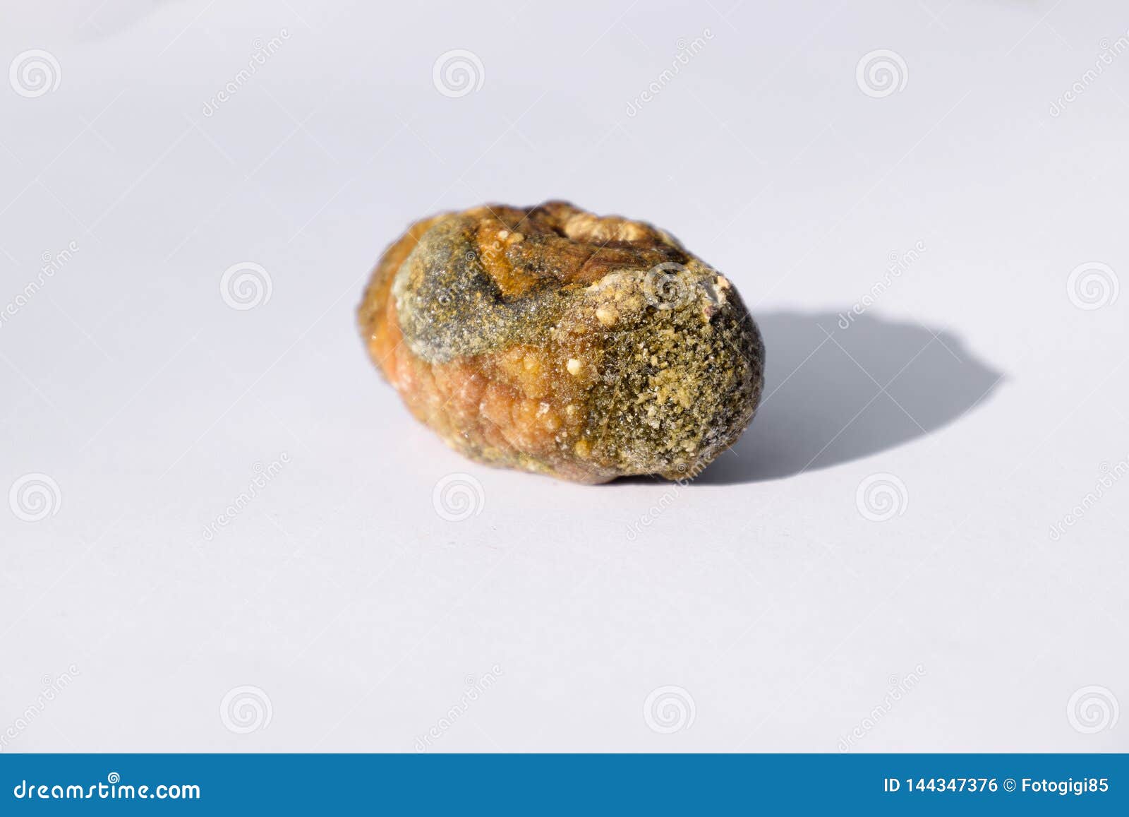 Stone of Gallbladder. the Result of Gallstones. a Calculus of ...