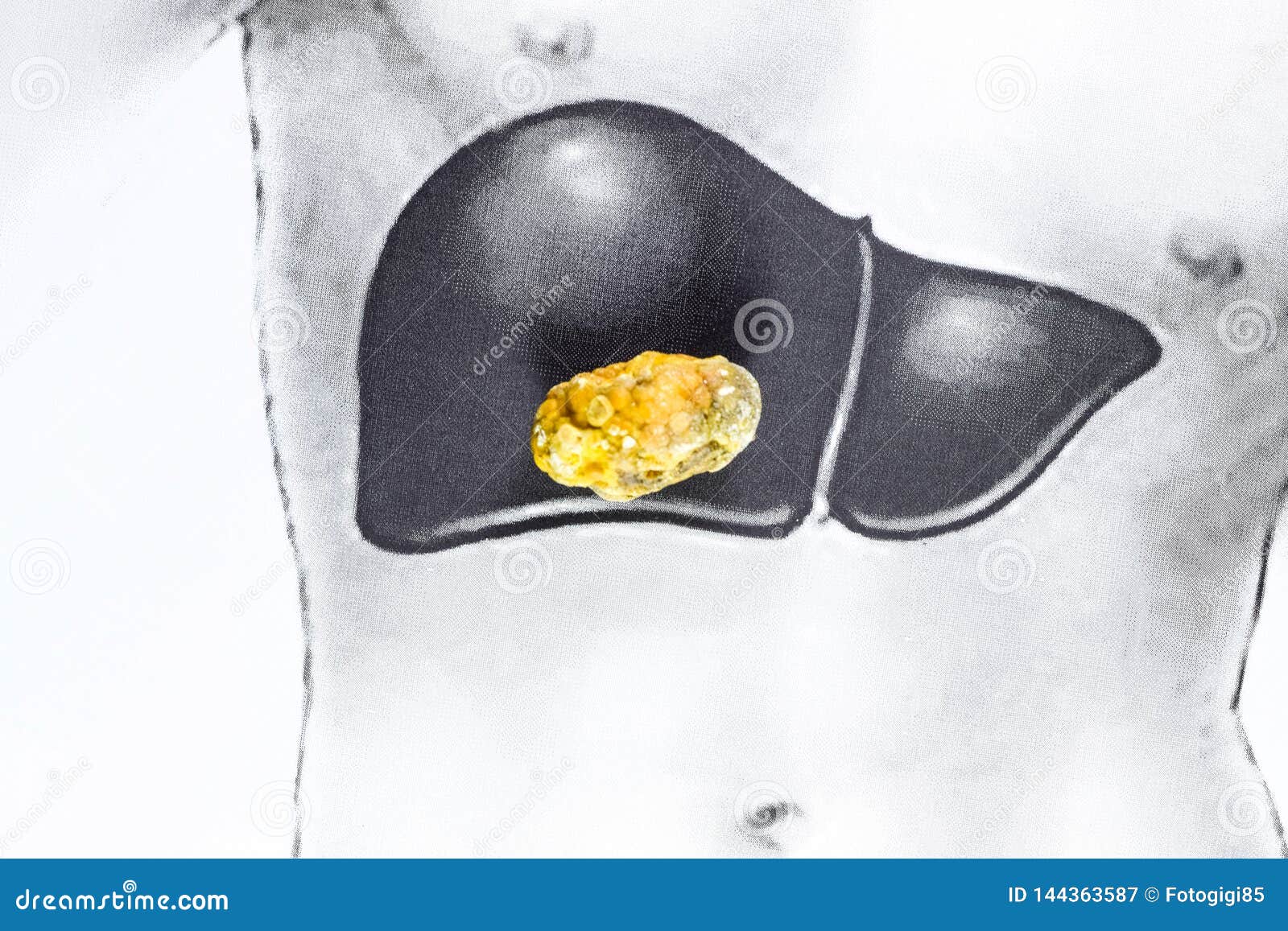 Stone in the Liver, Schematic Image, a Large Gallstone, the Result of ...