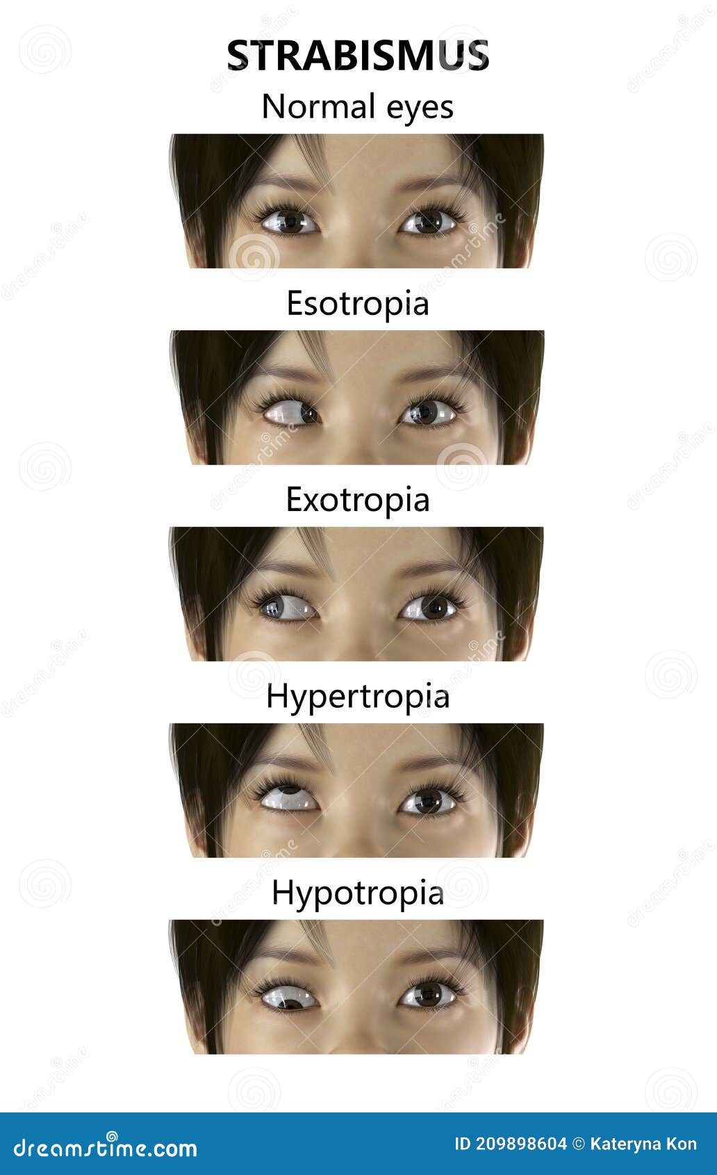 Strabismus In Children, Illustration | CartoonDealer.com #207421566
