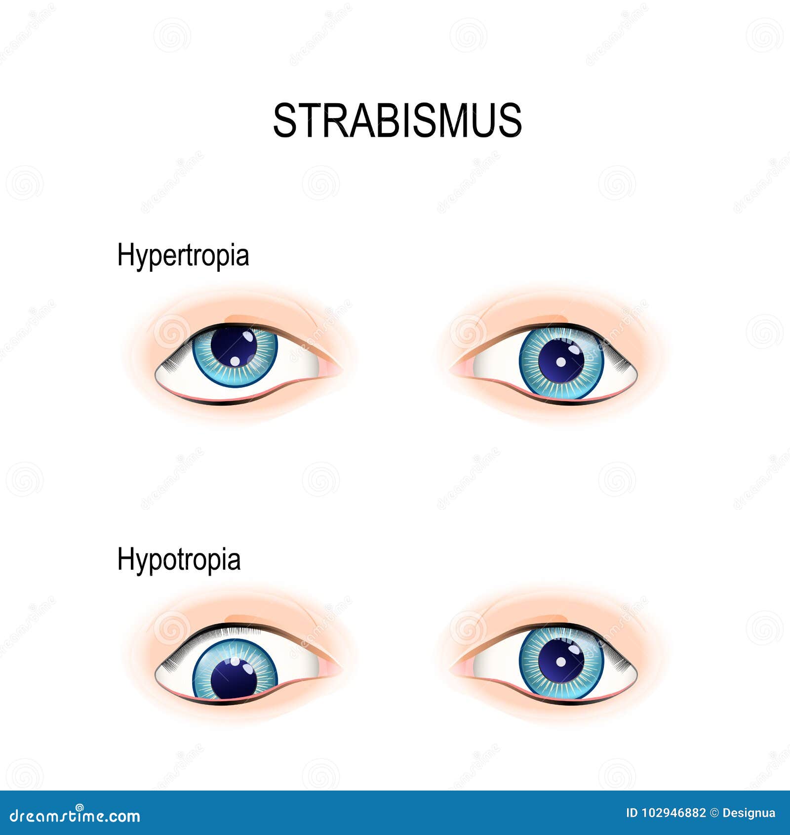 Strabismus. crossed eyes stock vector. Illustration of medical - 102946882