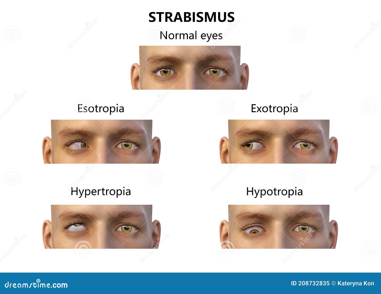Strabismus, Eyes Deviation, Illustration Stock Illustration ...