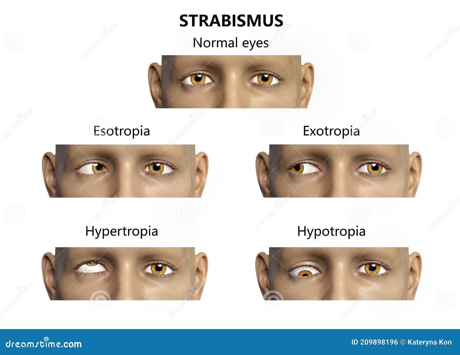 Strabismus, Eyes Deviation, Illustration Stock Illustration ...