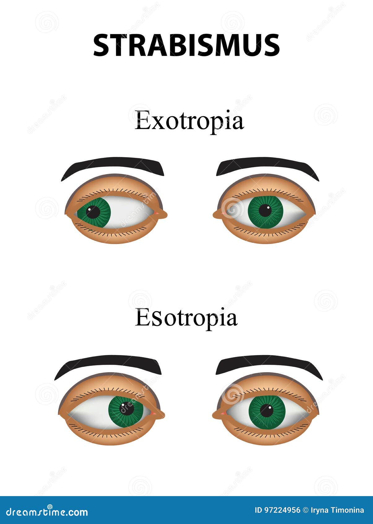 Esotropia Cartoons, Illustrations & Vector Stock Images - 102 Pictures ...
