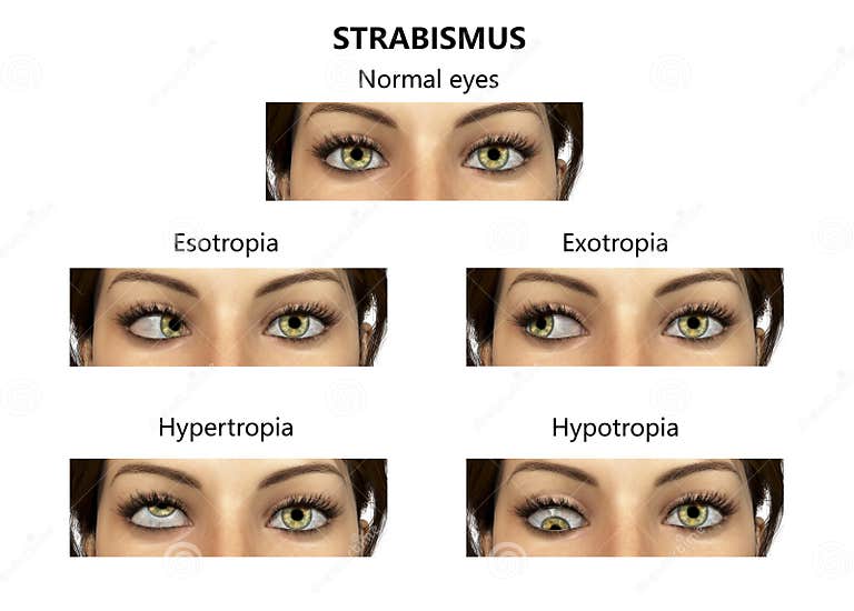 Strabismus, Eyes Deviation, Illustration Stock Illustration ...