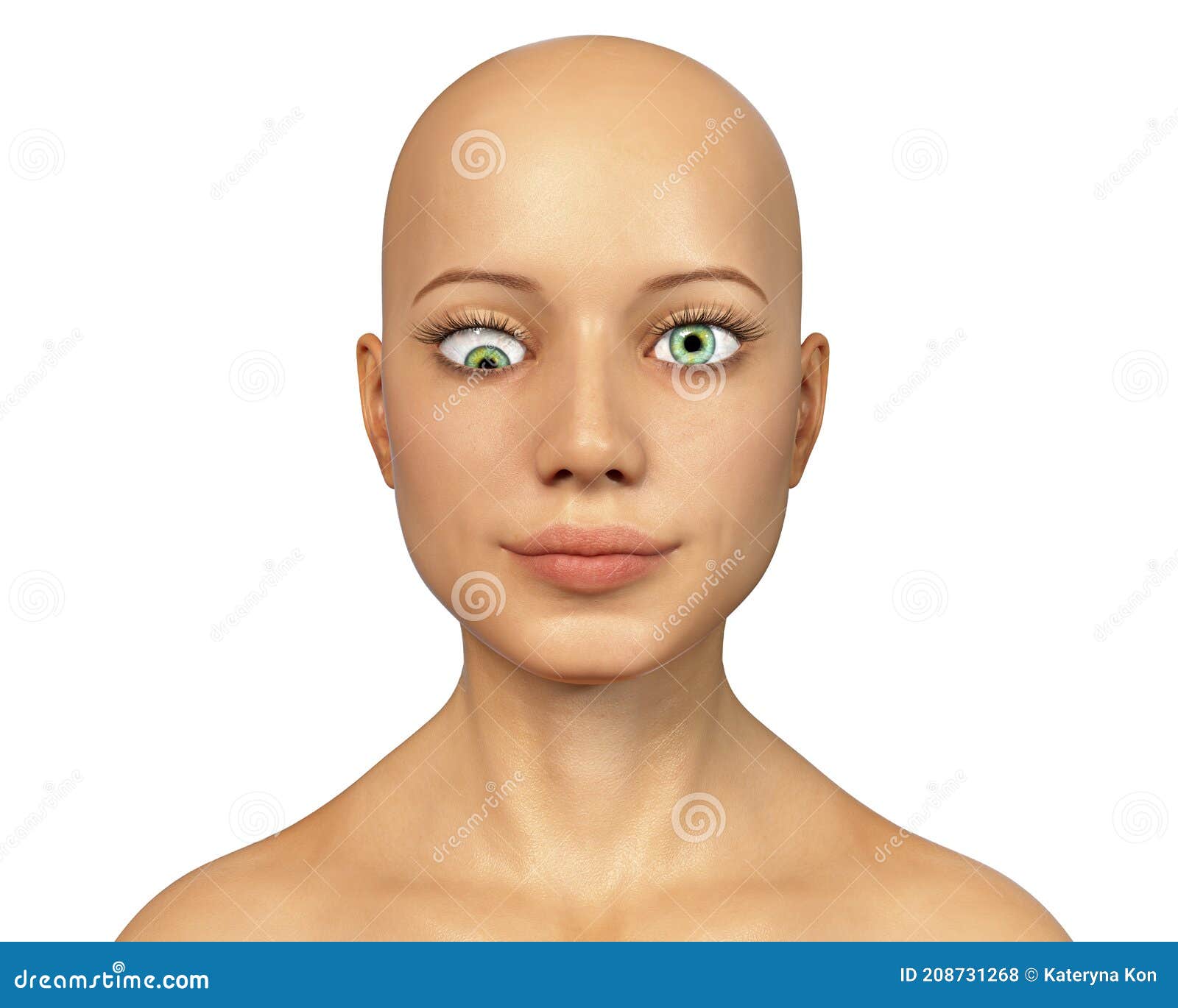 Strabismus, Eyes Deviation, Illustration Stock Illustration ...