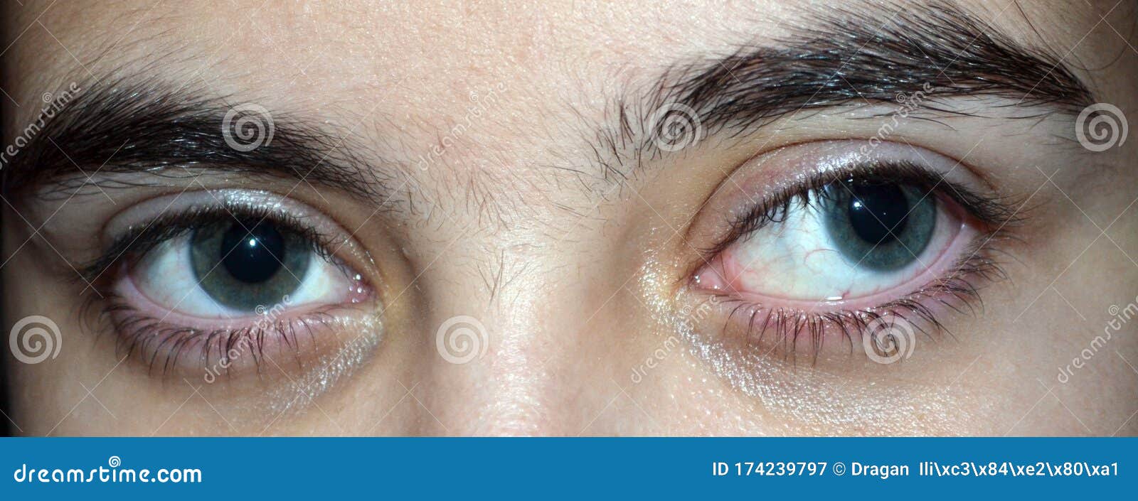 Strabismus Eye Surgery. Close Up Of Crazy Female Eyes With Squint. Eye ...