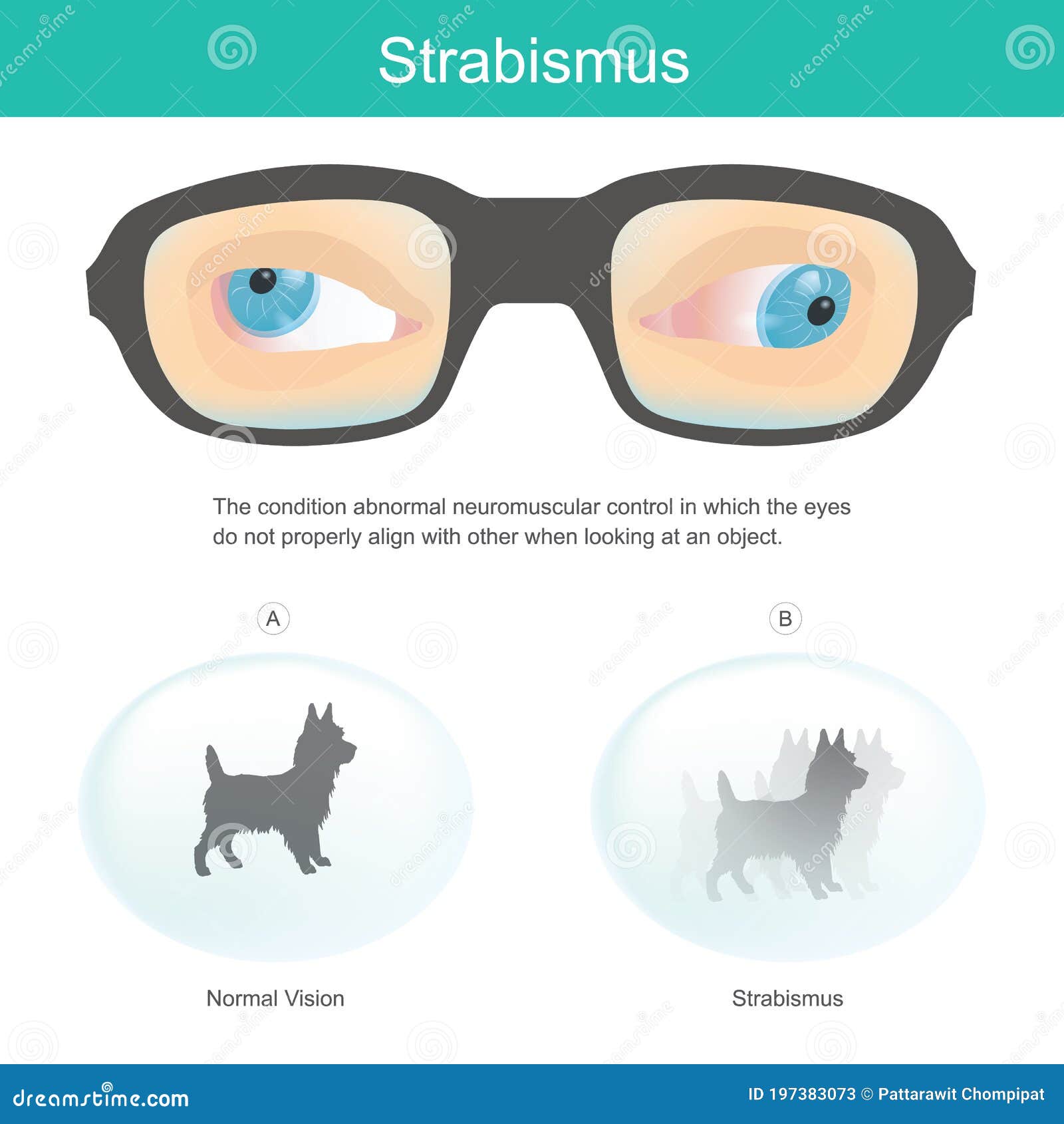 Strabismus, Eyes Deviation, Illustration | CartoonDealer.com #208732191