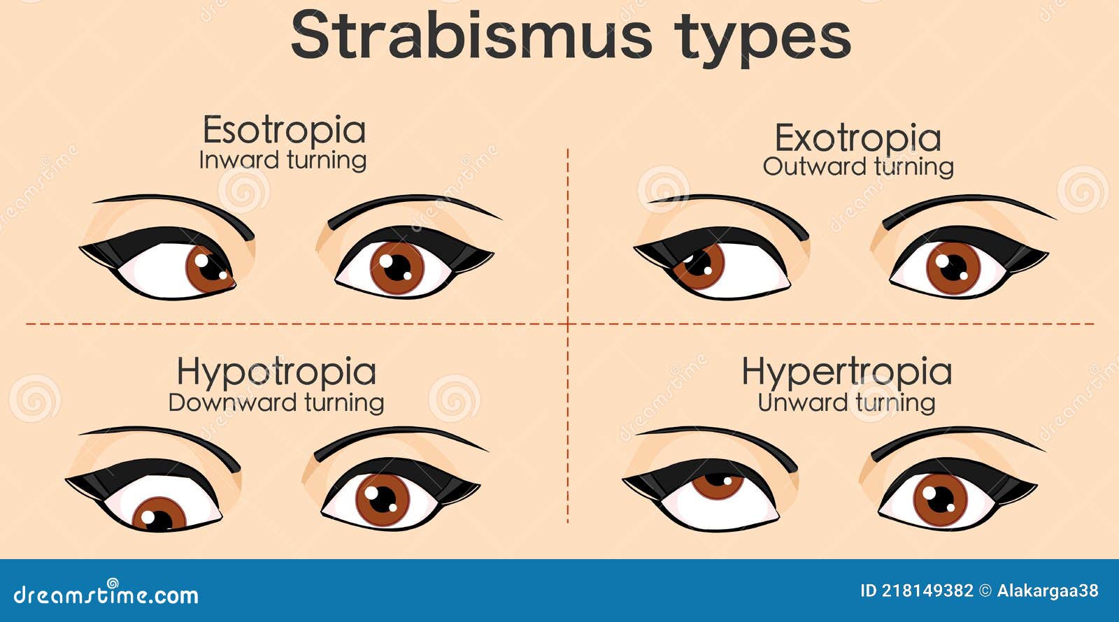 Strabismus Types Woman Crossed Eyes. Esotropia, Inward Turning, Outward ... Strabismus Types Woman Crossed Eyes. Esotropia, Inward Turning, Outward ...