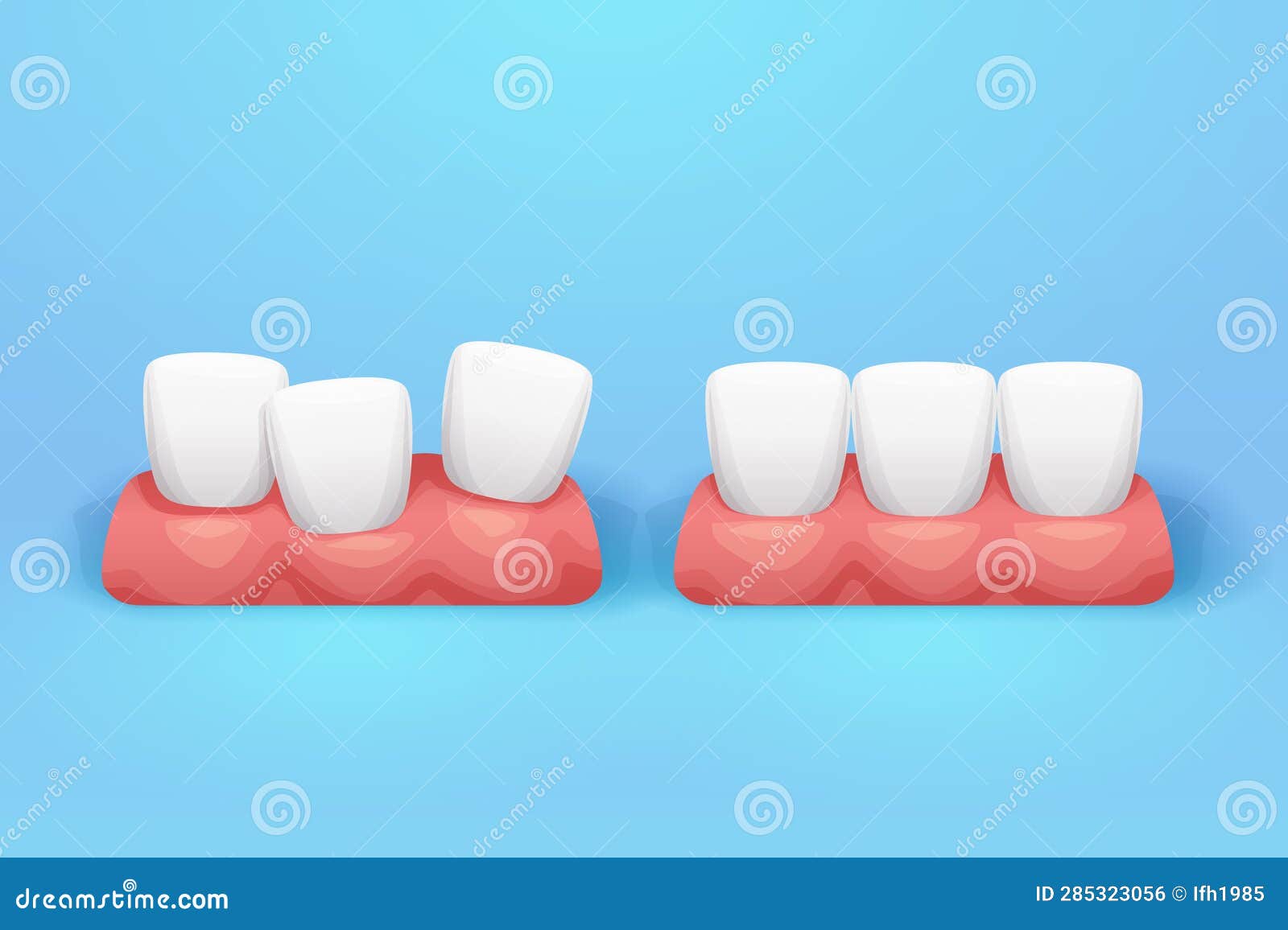 Straight and Crooked Teeth on Blue Back Stock Vector - Illustration of ...