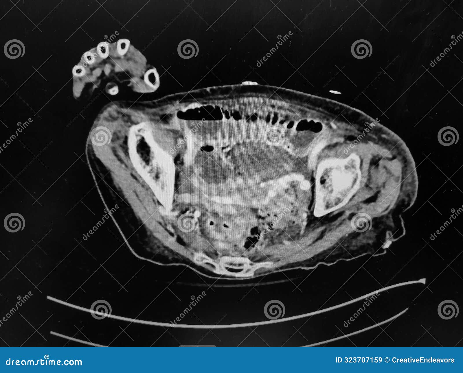 Strangulated Small Bowel Loop - R Obturator Hernia Stock Image - Image ...