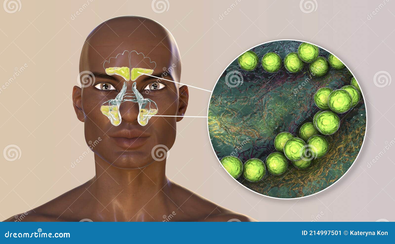 Streptococcus Pyogenes Bacteria and Other Streptococci As a Cause of ...