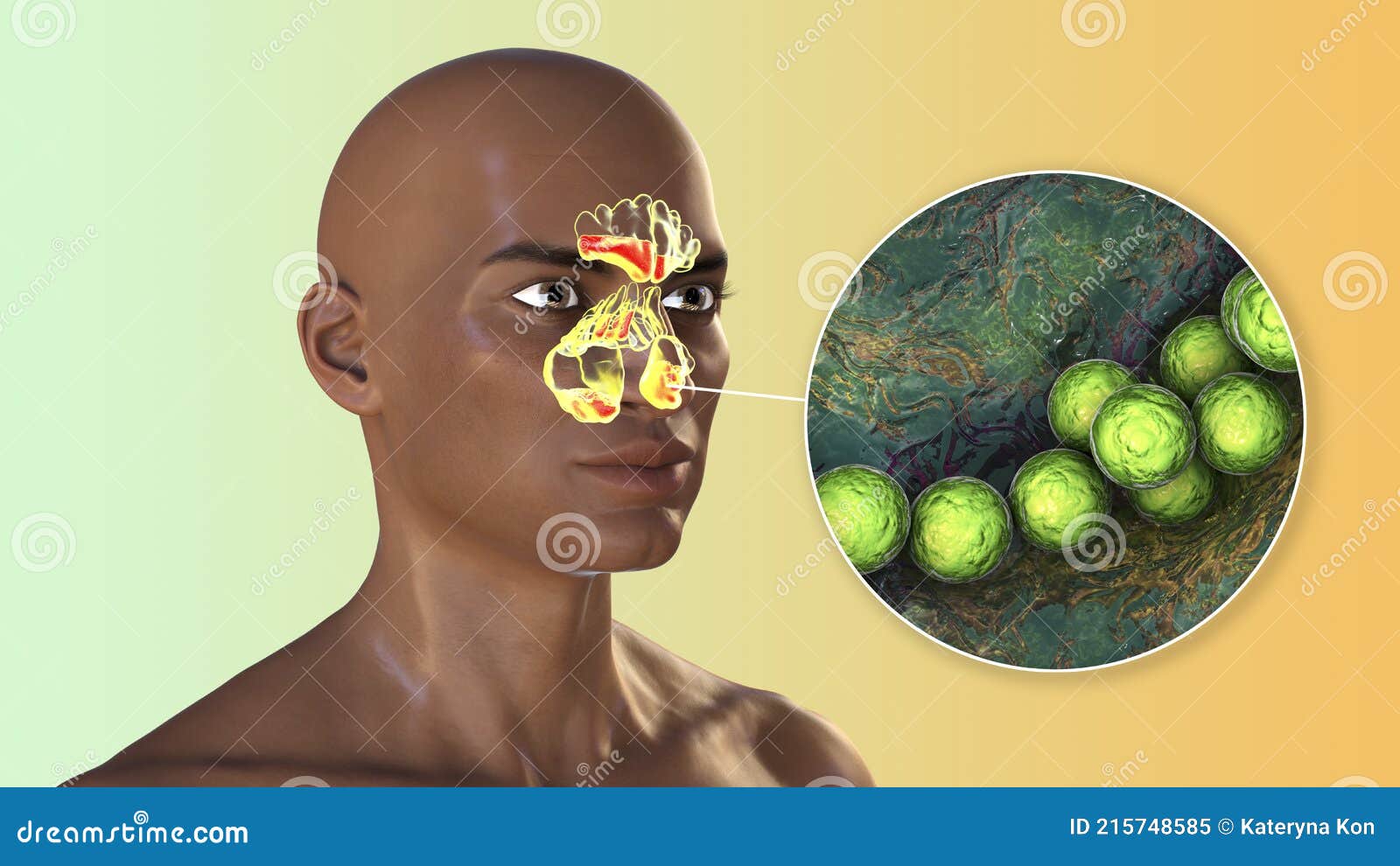 Streptococcus Pyogenes Bacteria and Other Streptococci As a Cause of ...