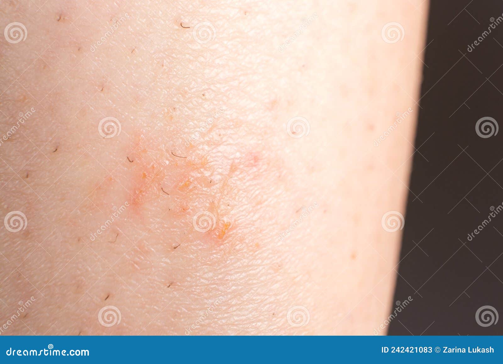 Streptoderma - Dermatitis on Human Skin, Red Round Spot, Macro ...