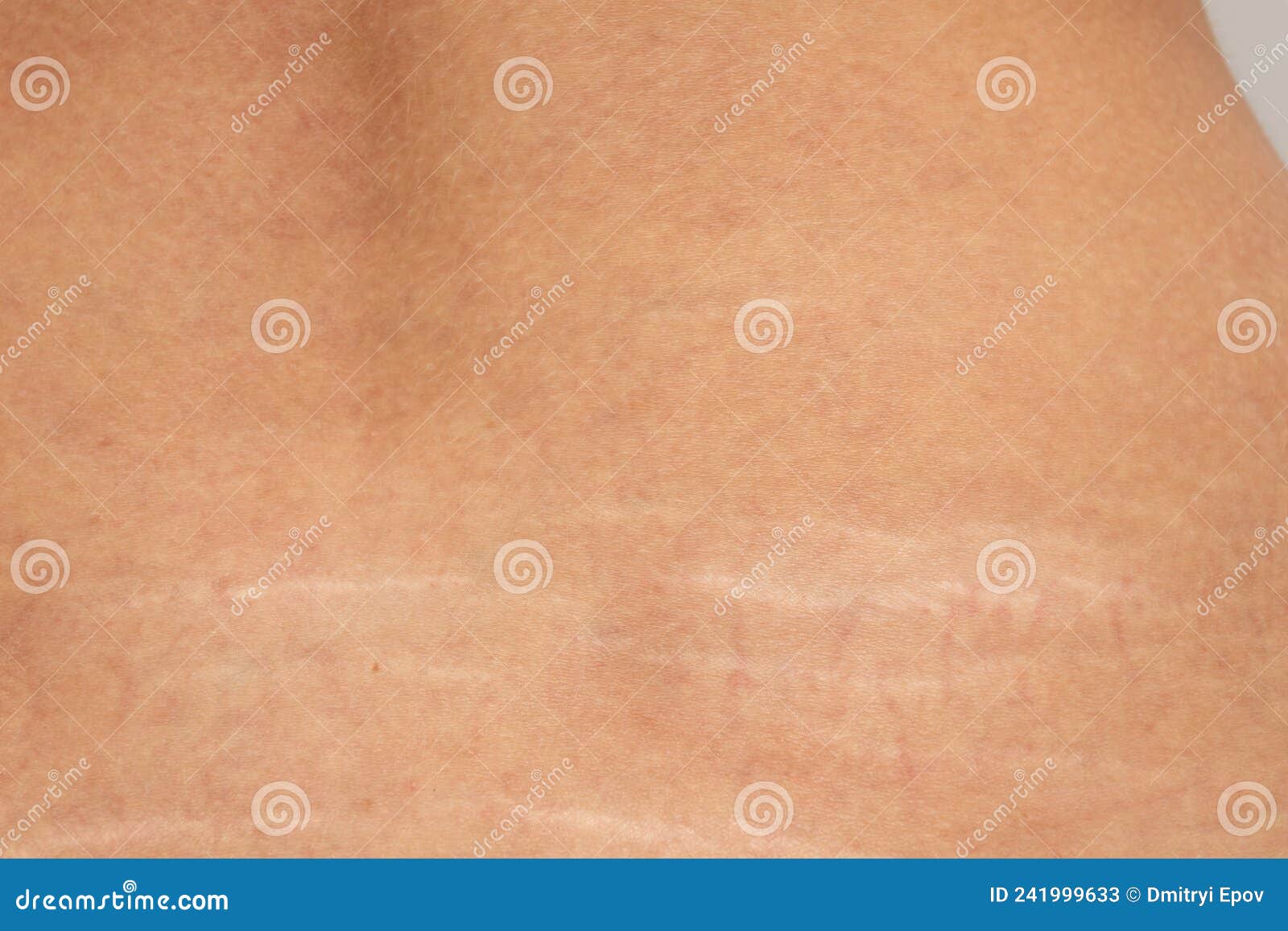 Stretch Marks on the Lower Back Stock Image - Image of loss, human ...