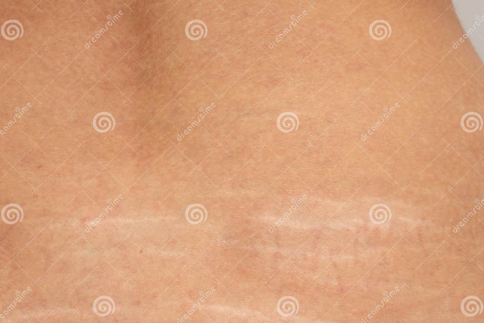 Stretch Marks on the Lower Back Stock Image - Image of loss, human ...