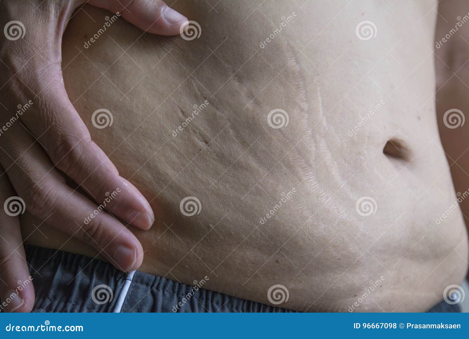 Stretch marks stock photo. Image of health, beauty, human - 96667098