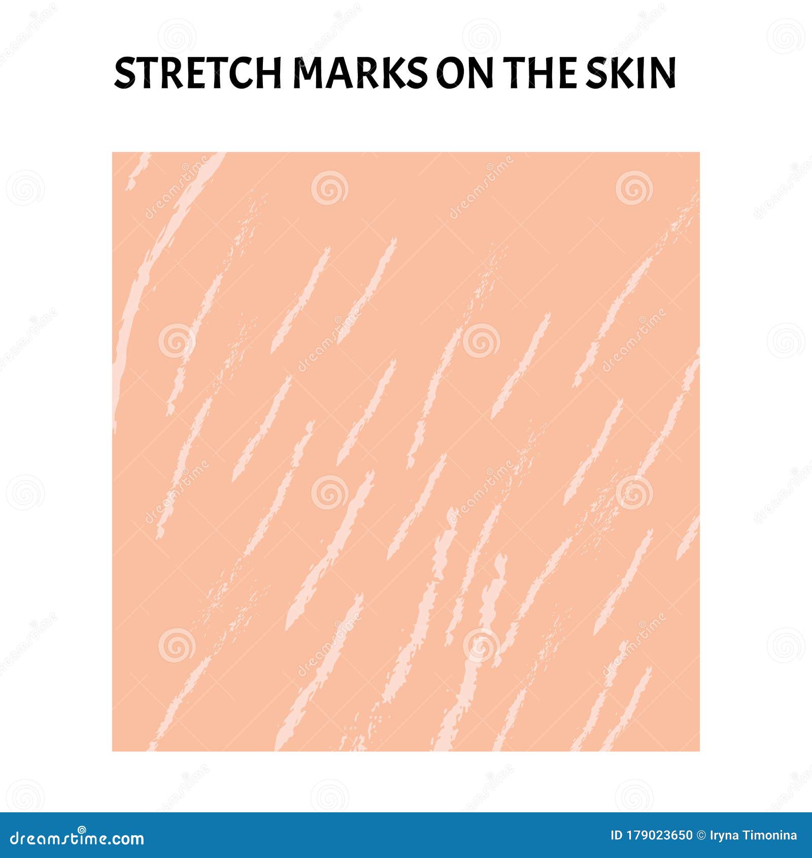Stretch Marks on the Skin. Background Stretch Marks on the Skin ...