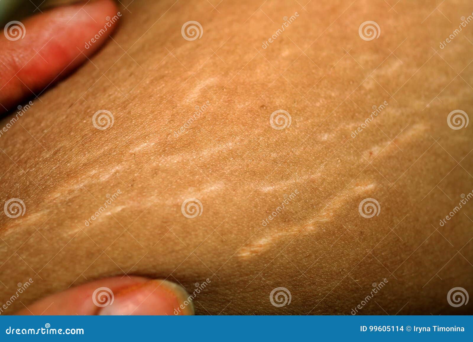 Stretch Marks on the Skin. Scars on the Body. Stretch Marks on Legs ...