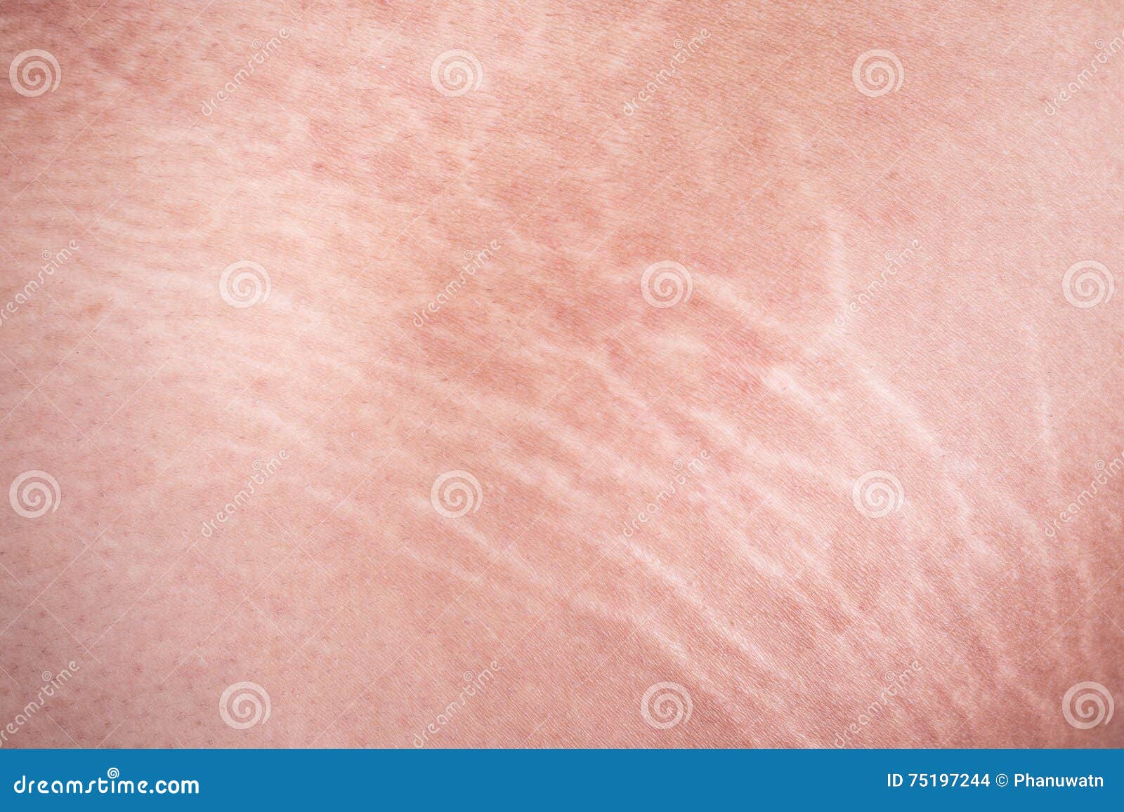 Stretch Marks of Skin on the Thigh Stock Photo - Image of female ...