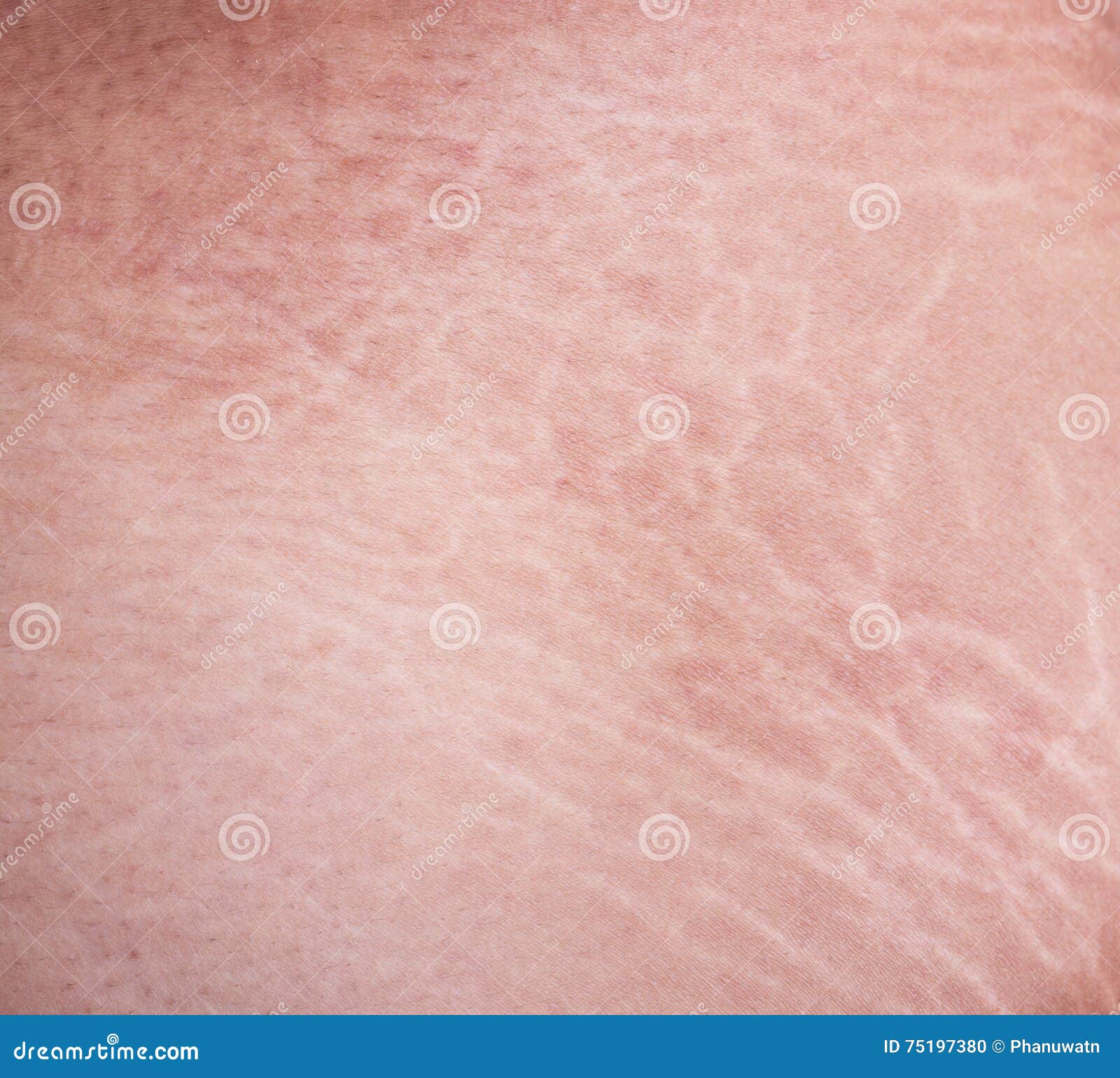 Stretch Marks of Skin on the Thigh Stock Photo - Image of skin ...