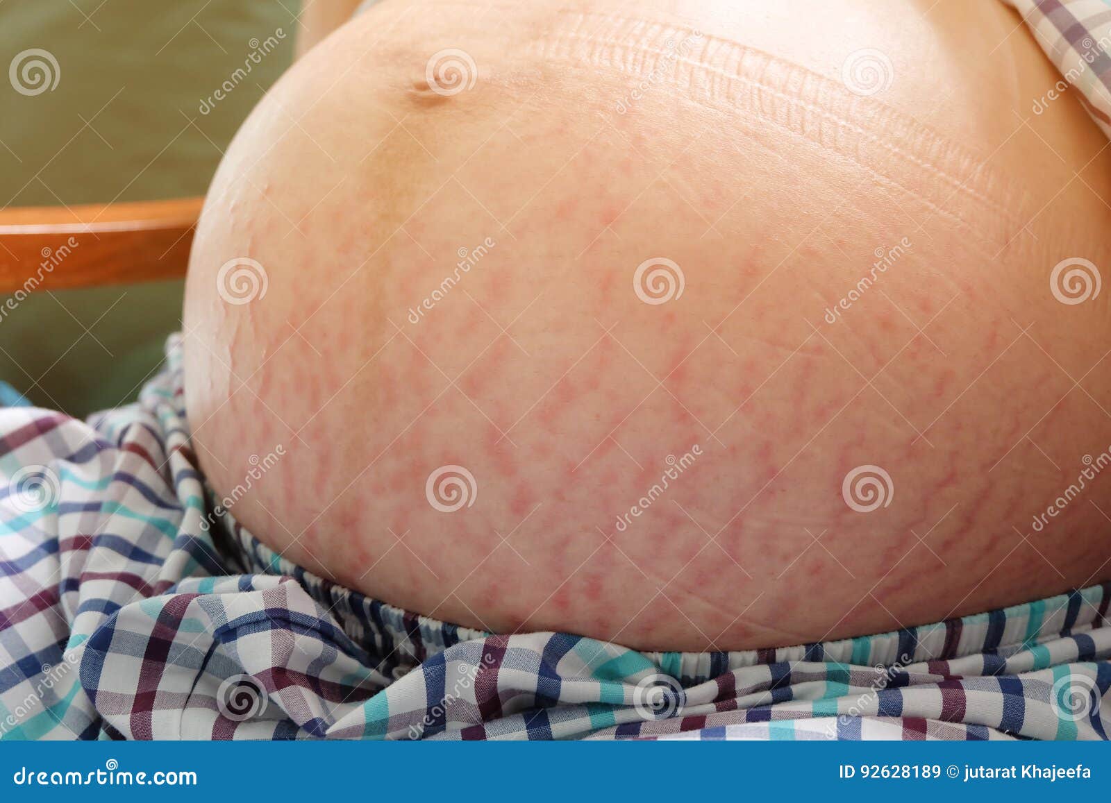 Stretched Mark Skin stock image. Image of scar, body - 92628189