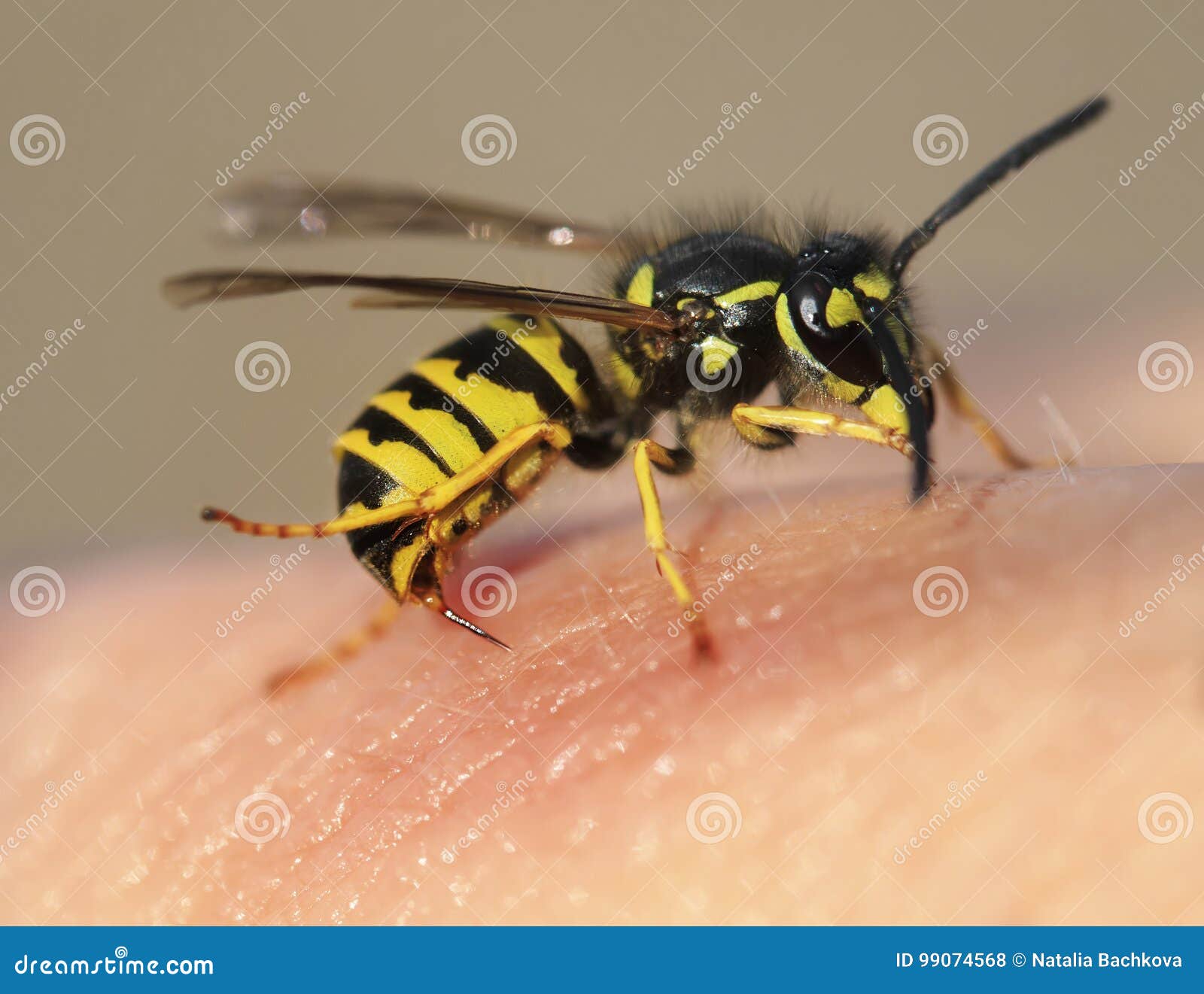 Striped Angry Wasp Stuck a Sharp Thorn in the Human Skin Stock Photo ...