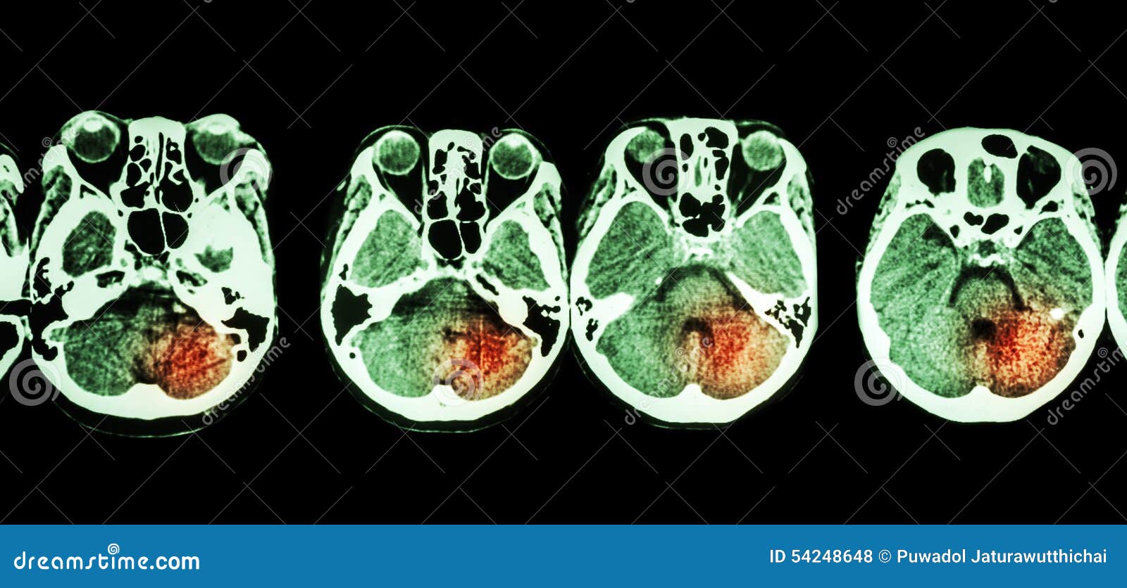 Stroke ( CT Scan of Brain and Base of Skull and Stroke ) Stock Photo ...