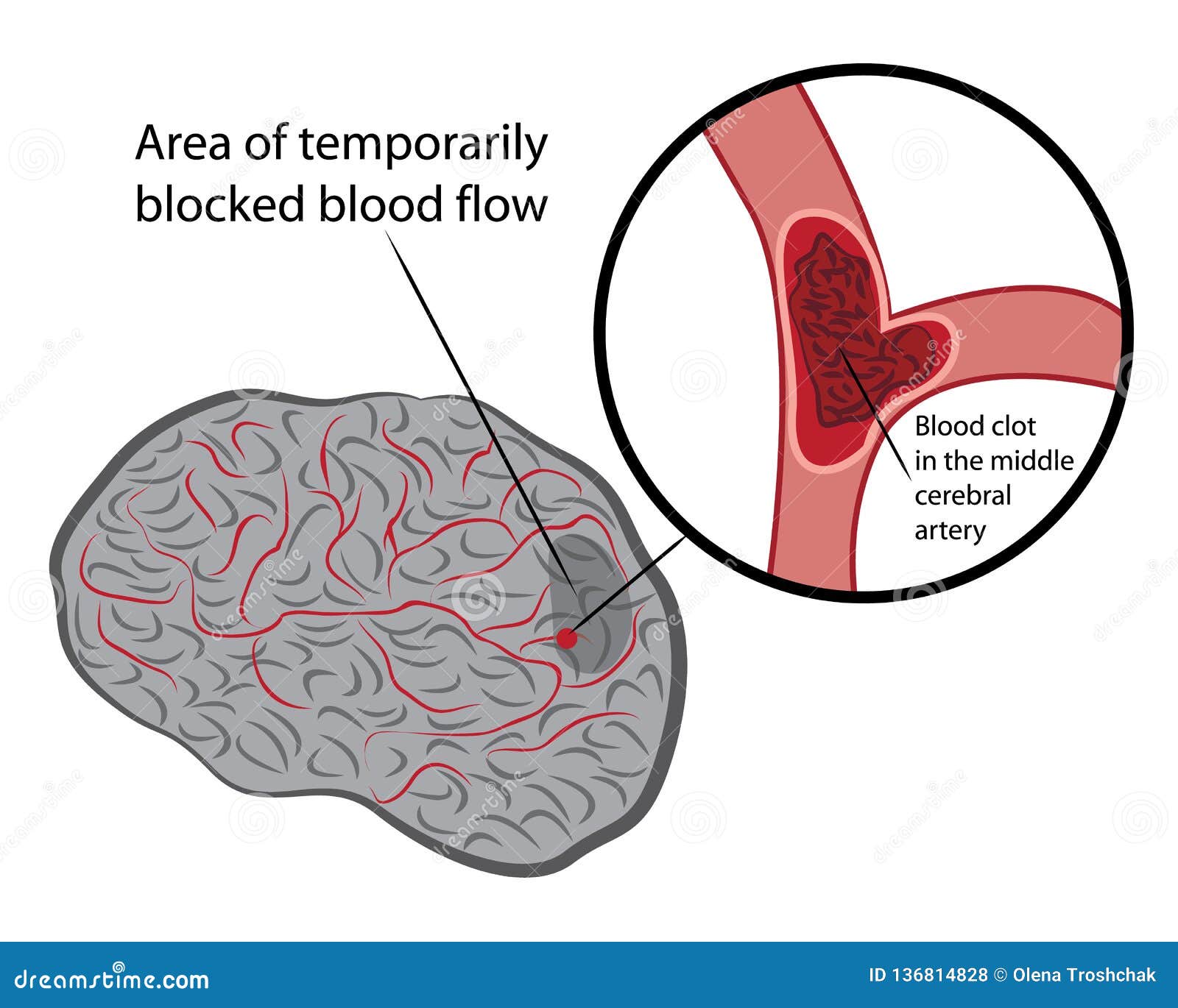 Stroke Develope in Human Brains Stock Vector - Illustration of clots ...