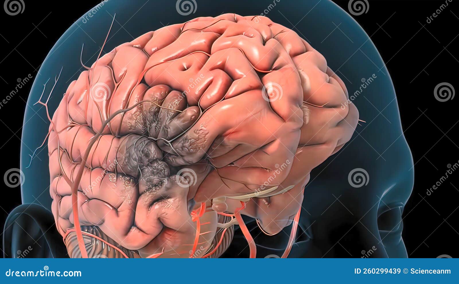 A Stroke, Sometimes Called a Brain Attack Stock Illustration ...