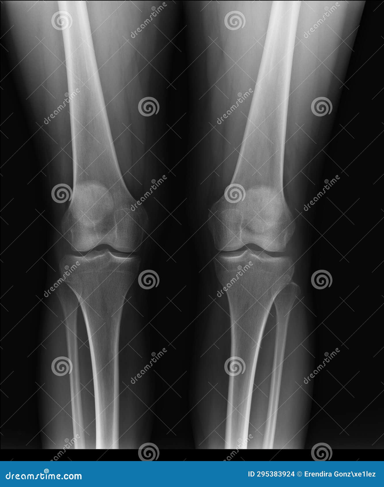 Strong legs on x-ray stock photo. Image of strong, bones - 295383924