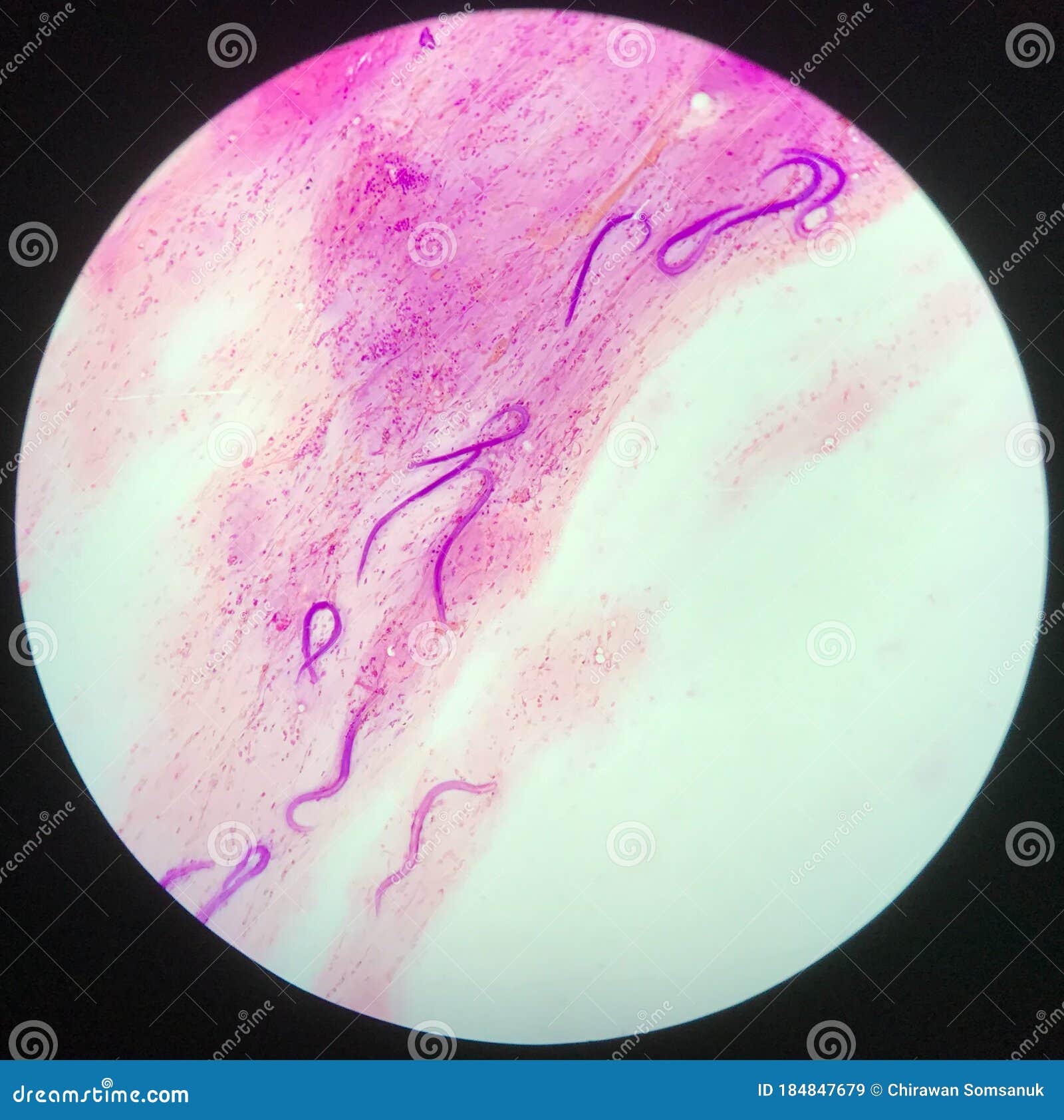 Strongyloides Stercoralis Parasit in Human Stock Image - Image of ...