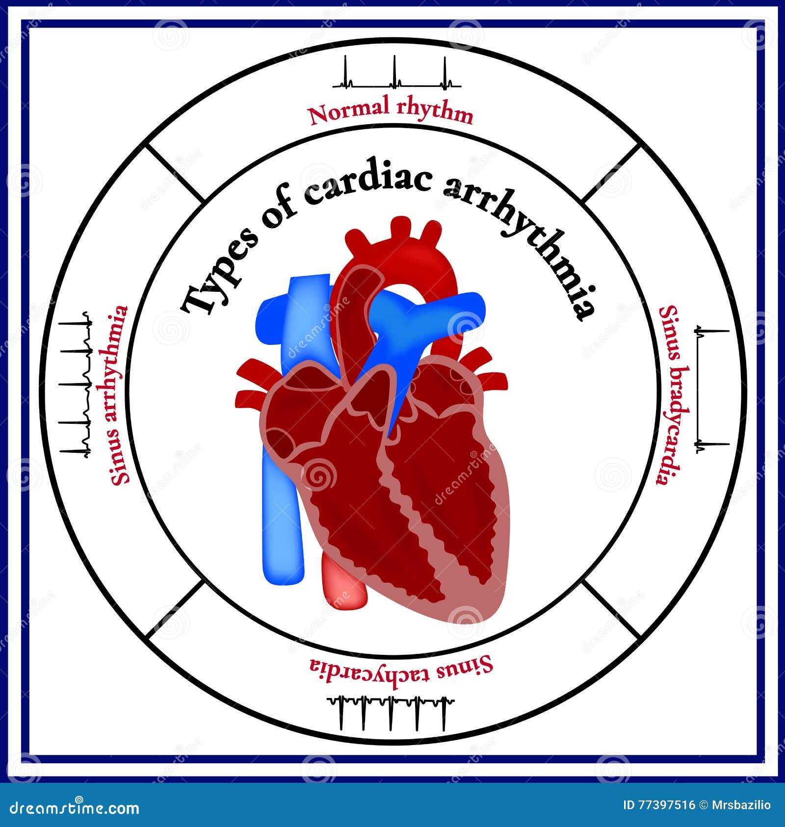 Structure De Coeur Types D'arythmie Du Coeur Illustration de Vecteur ...
