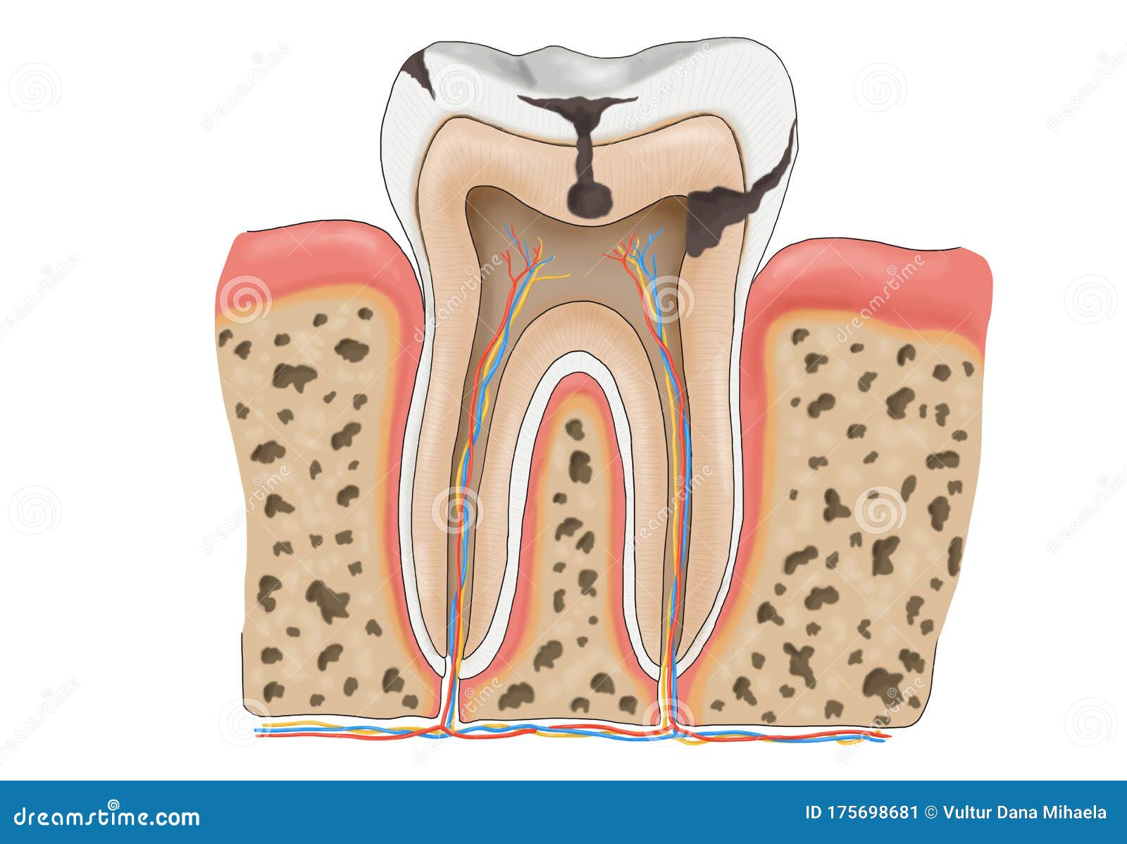 Structure of a Decayed Tooth Stock Illustration - Illustration of ...