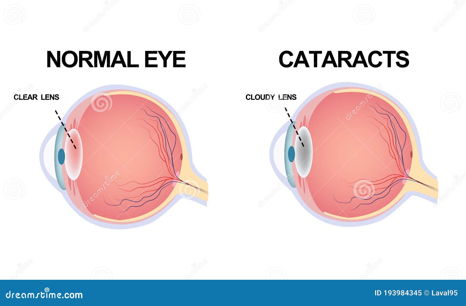 The Structure Of The Eye. Cataract Cartoon Vector | CartoonDealer.com ...