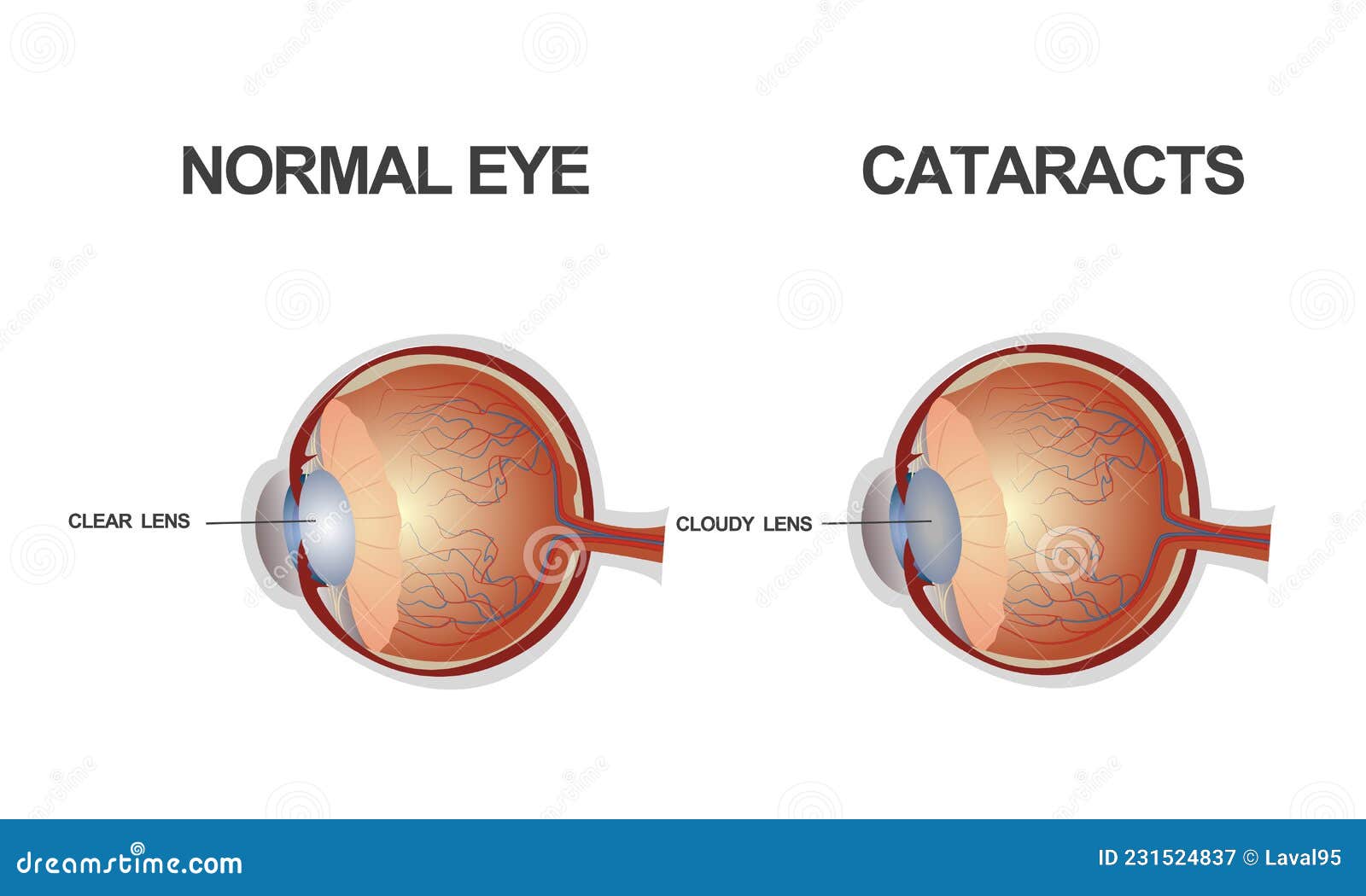 The Structure Of The Eye. Cataract Cartoon Vector | CartoonDealer.com ...