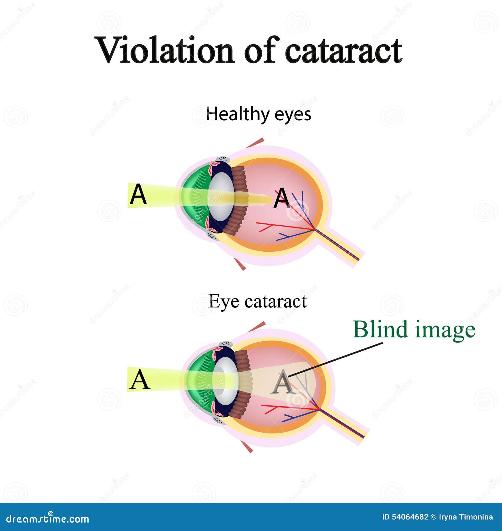 The Structure Of The Eye. Cataract Cartoon Vector | CartoonDealer.com ...
