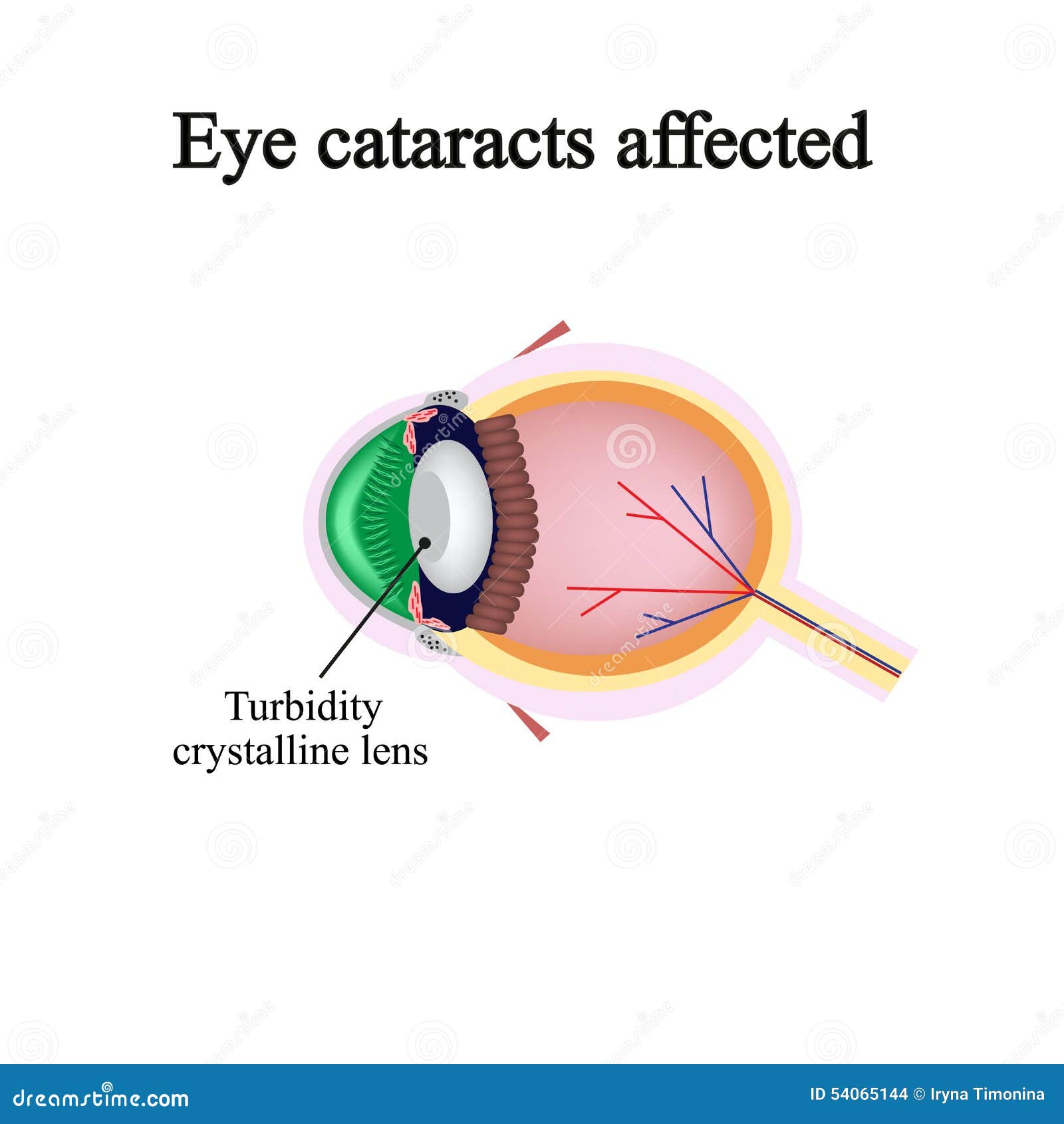 The Structure of the Eye. Eye Cataracts Affected Stock Vector ...