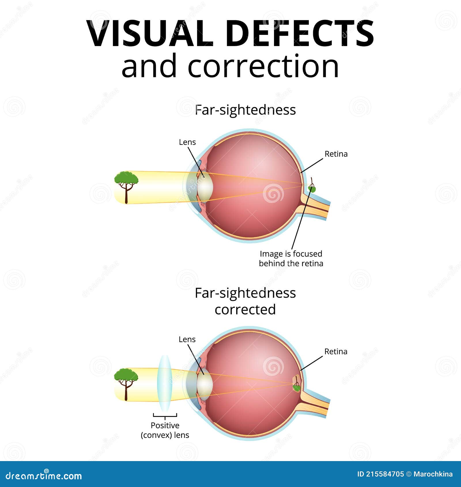 Structure of the Eyeball, Visual Impairment, Farsightedness Stock ...