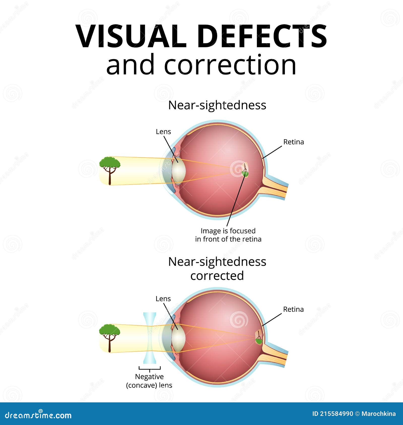 Structure of the Eyeball, Visual Impairment, Near-sightedness Stock ...