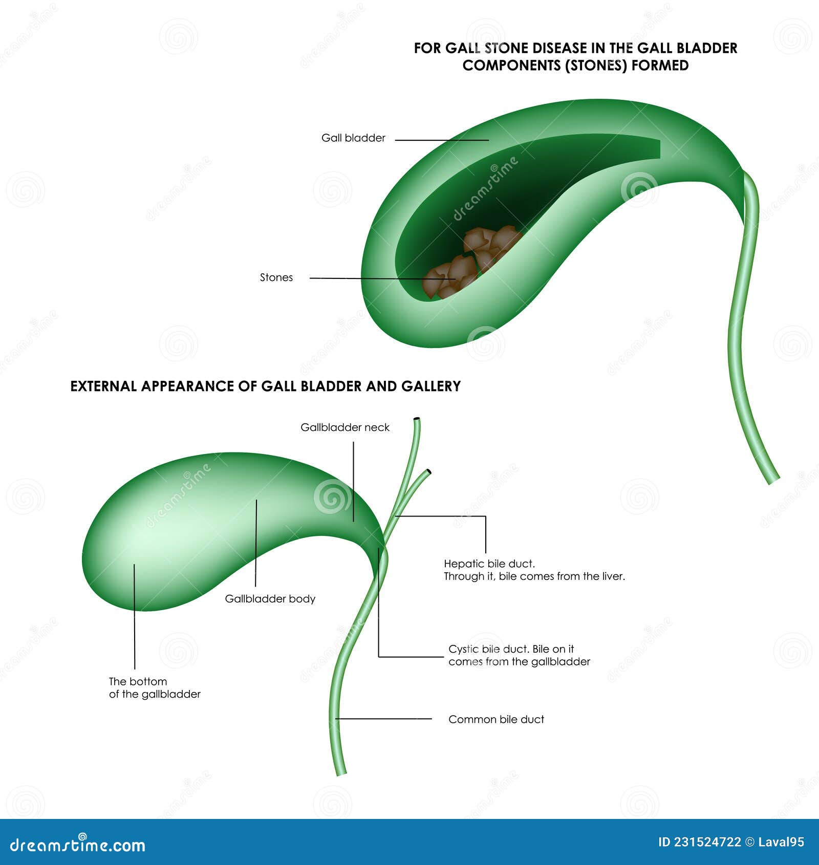 The Structure of the Gallbladder and Stones in the Gallbladder ...
