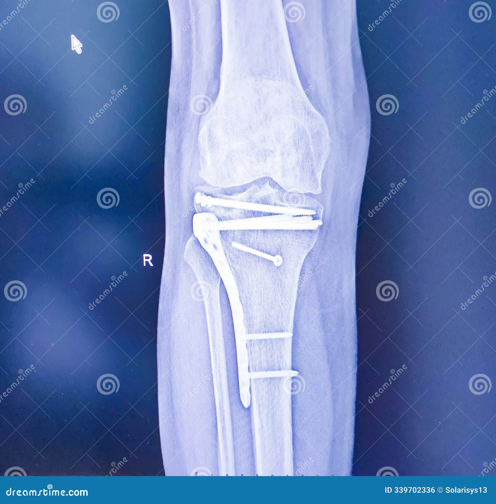Structure of Knee and Rx-ray Image of Knee, Tibia Fracture with Post ...