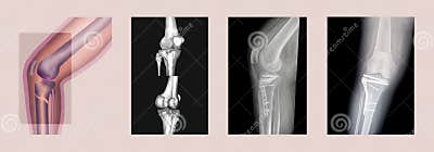Structure of Knee and Rx-ray Image of Knee, Tibia Fracture with Post ...